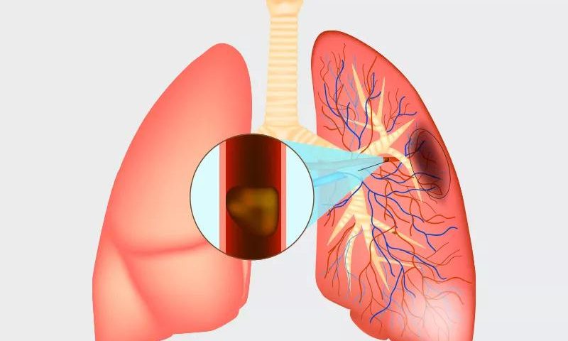 Embolia pulmonar: entenda como prevenir a condição relacionada à ...